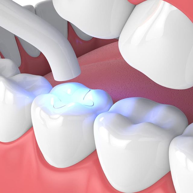 White Fillings Only – Pacific Dental Clinic